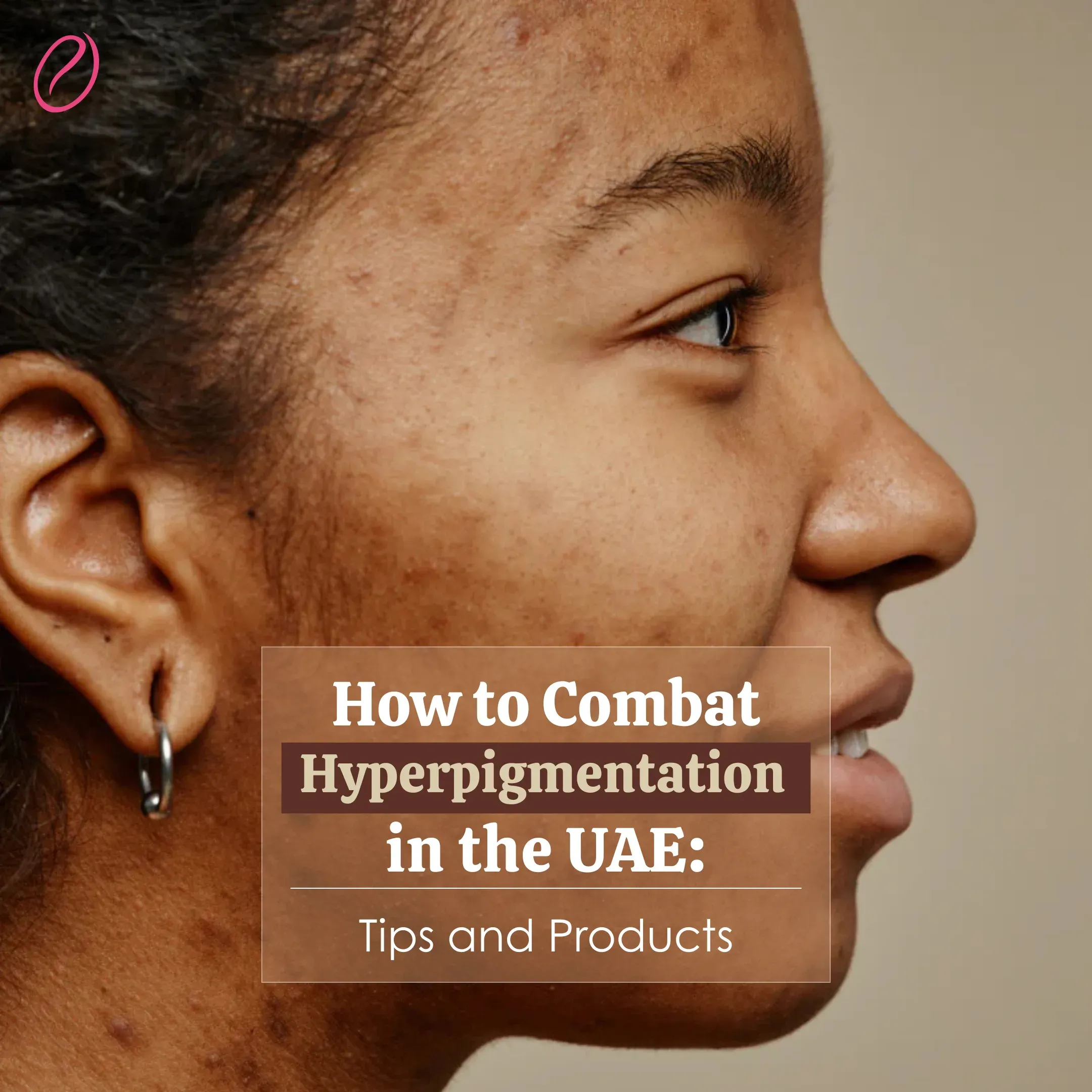 How to Combat Hyperpigmentation in the UAE: Tips and Products